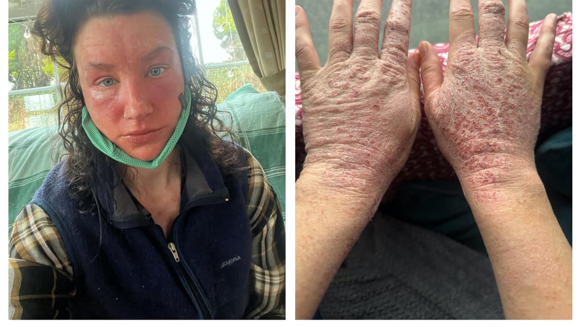 Pembrokeshire woman's skin 'on fire' after cream reaction: TSW ...